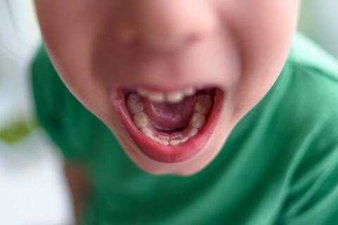 Shark Teeth in Kids: Causes, Treatment & When to See a Dentist