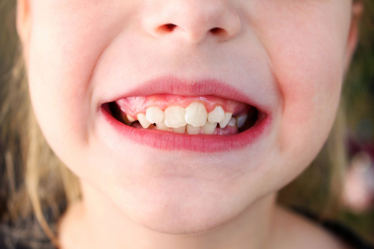 What To Do When Baby Teeth Won’t Fall Out